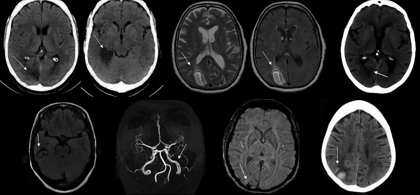 Hội chứng Alice ở xứ sở thần tiên (Alice In Wonderland Syndrome ...