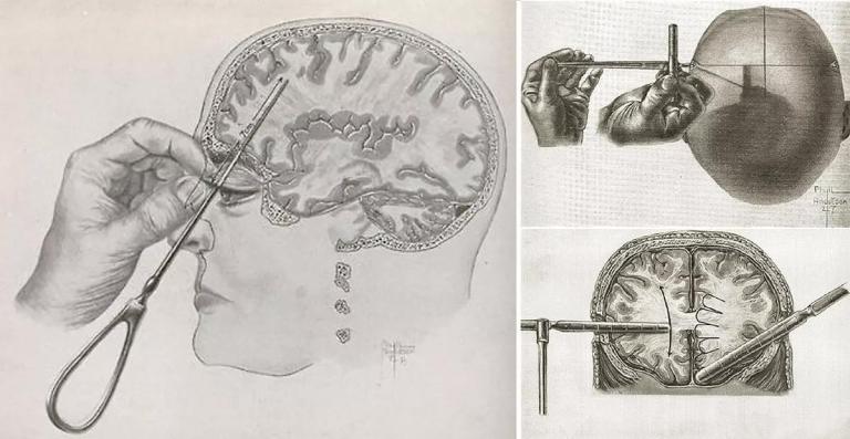 Phẫu thuật cắt thùy não (Lobotomy) – Exploring Psychology – Khám Phá ...